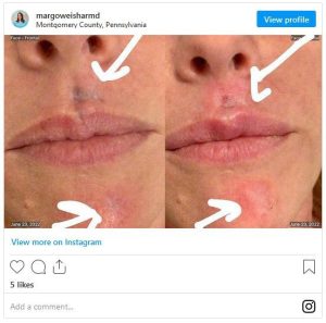 Traumatic Tattoo Treatment | PICO Laser